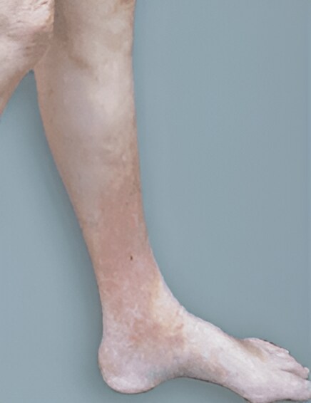 Before & After - StrideCare