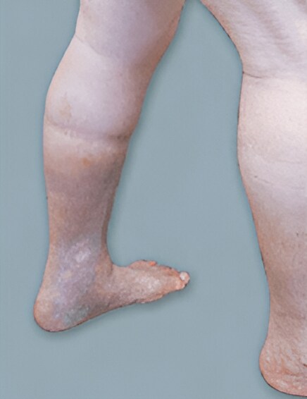 Before & After - StrideCare