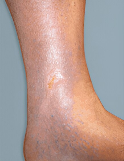 Before & After - StrideCare