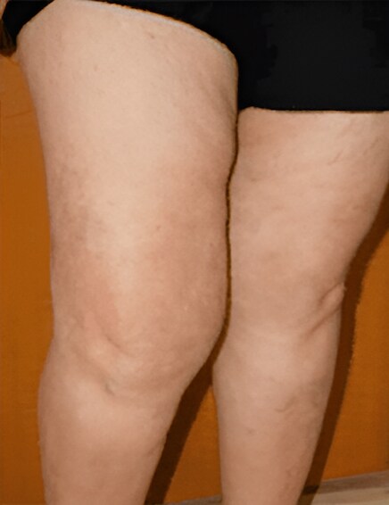 Before & After - StrideCare