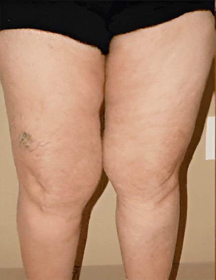 Before & After - StrideCare