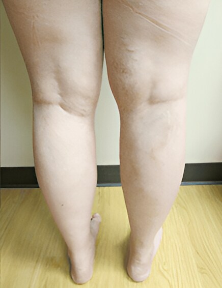 Before & After - StrideCare