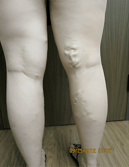 Before & After - StrideCare