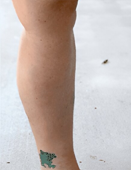 Before & After - StrideCare