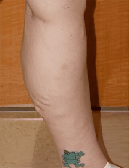 Before & After - StrideCare