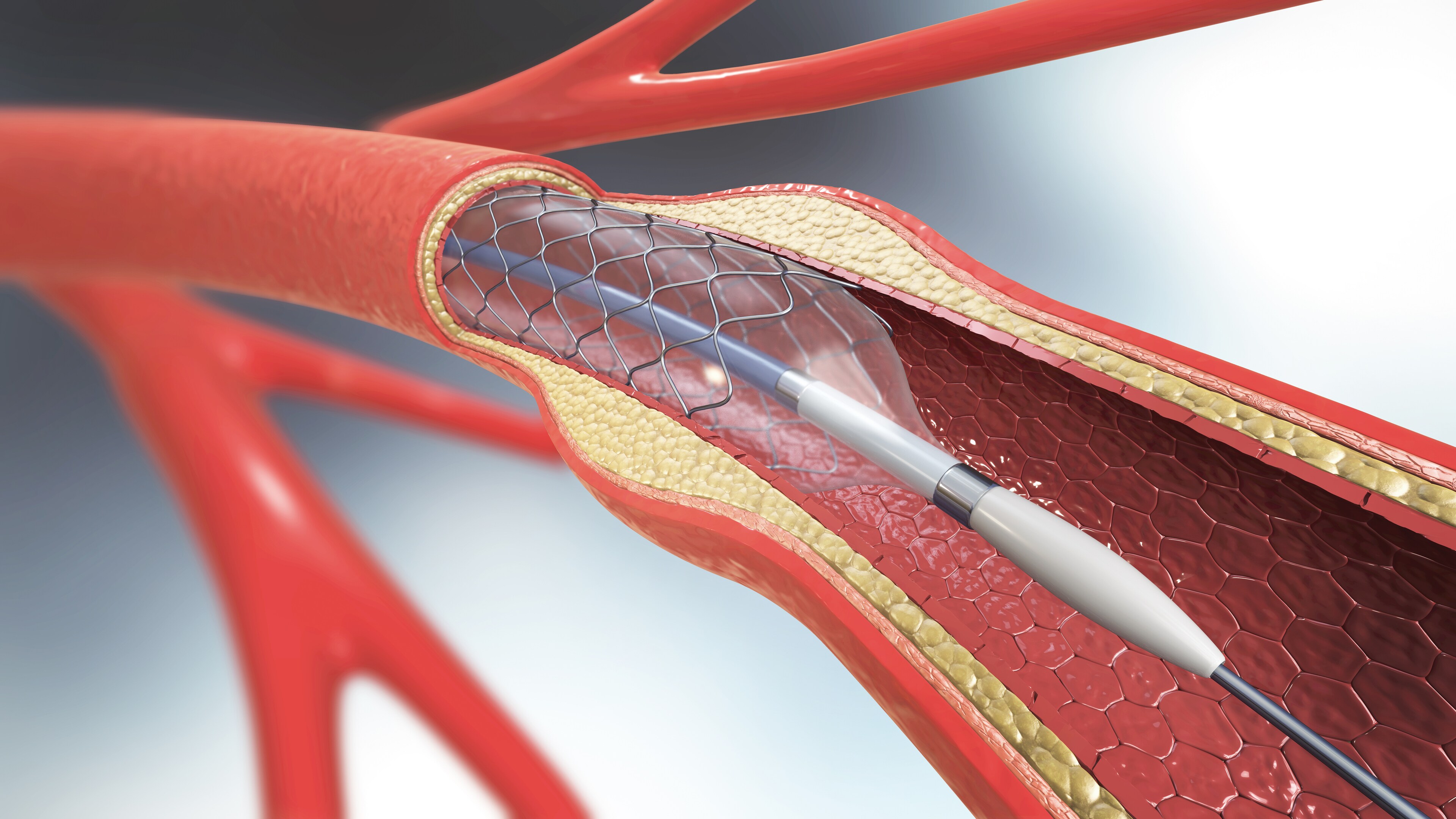 Stenting - StrideCare