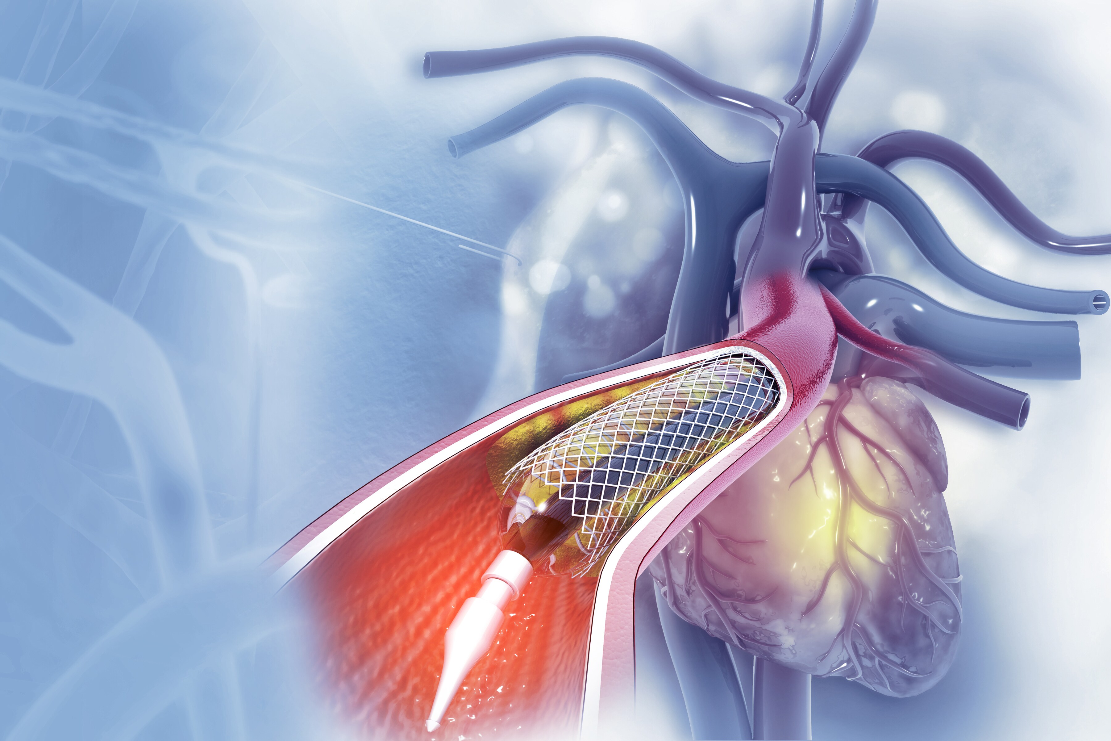 Stenting - StrideCare