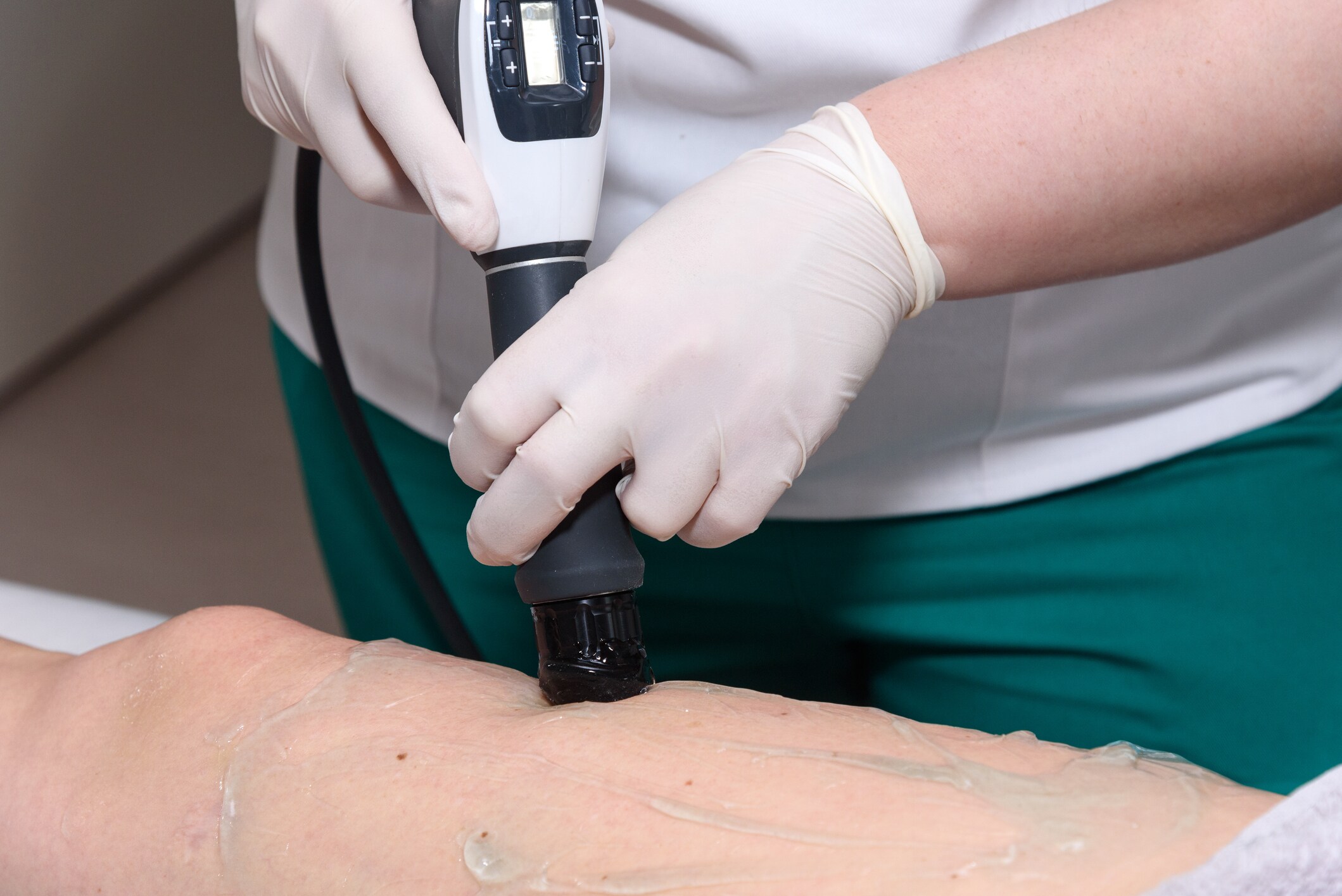 Varithena™ Microfoam Ablation - StrideCare