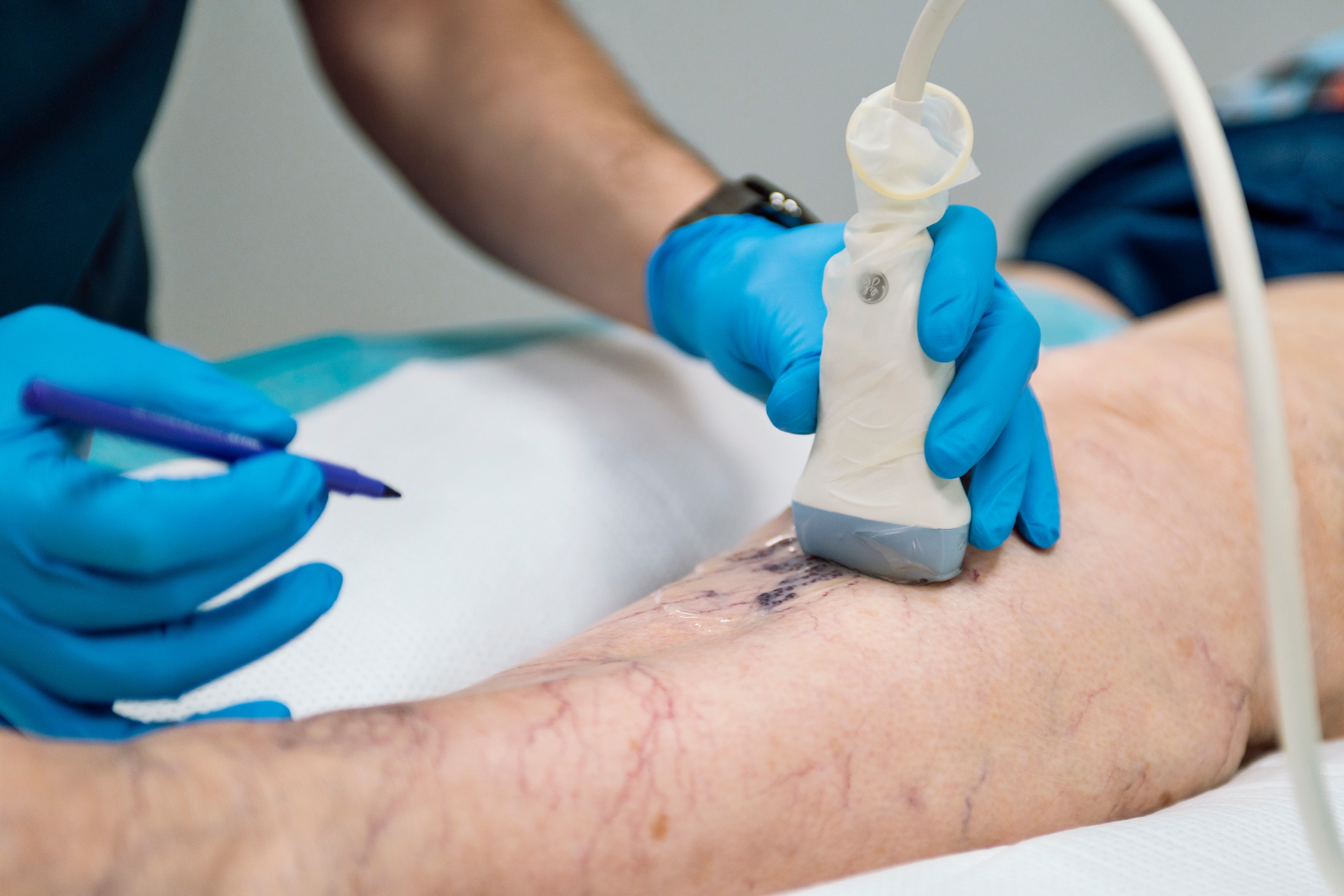 Venous Doppler Ultrasound - StrideCare