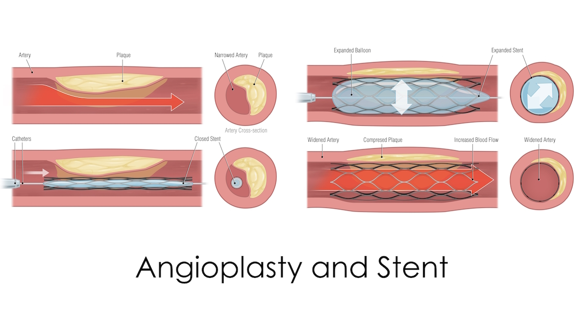 Is An Atherectomy for Artery Disease Treatment Right for Me? - StrideCare
