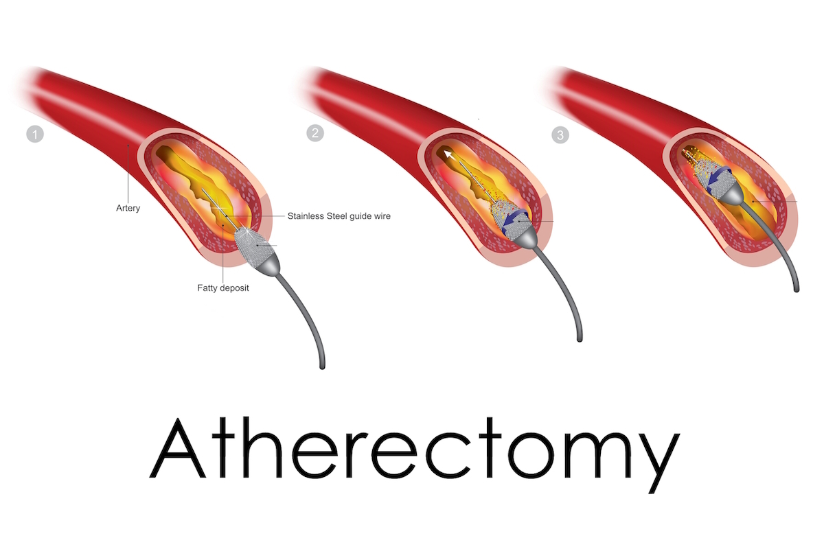 Is An Atherectomy for Artery Disease Treatment Right for Me? - StrideCare