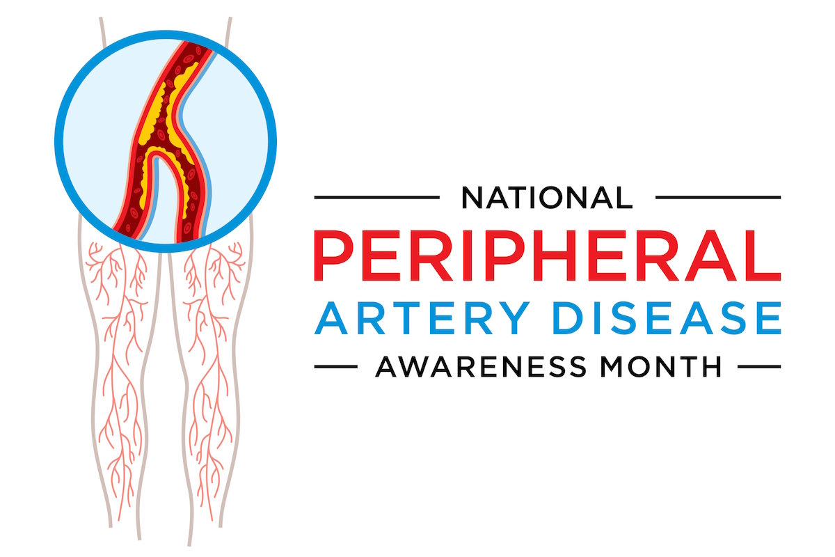 Is An Atherectomy for Artery Disease Treatment Right for Me? - StrideCare