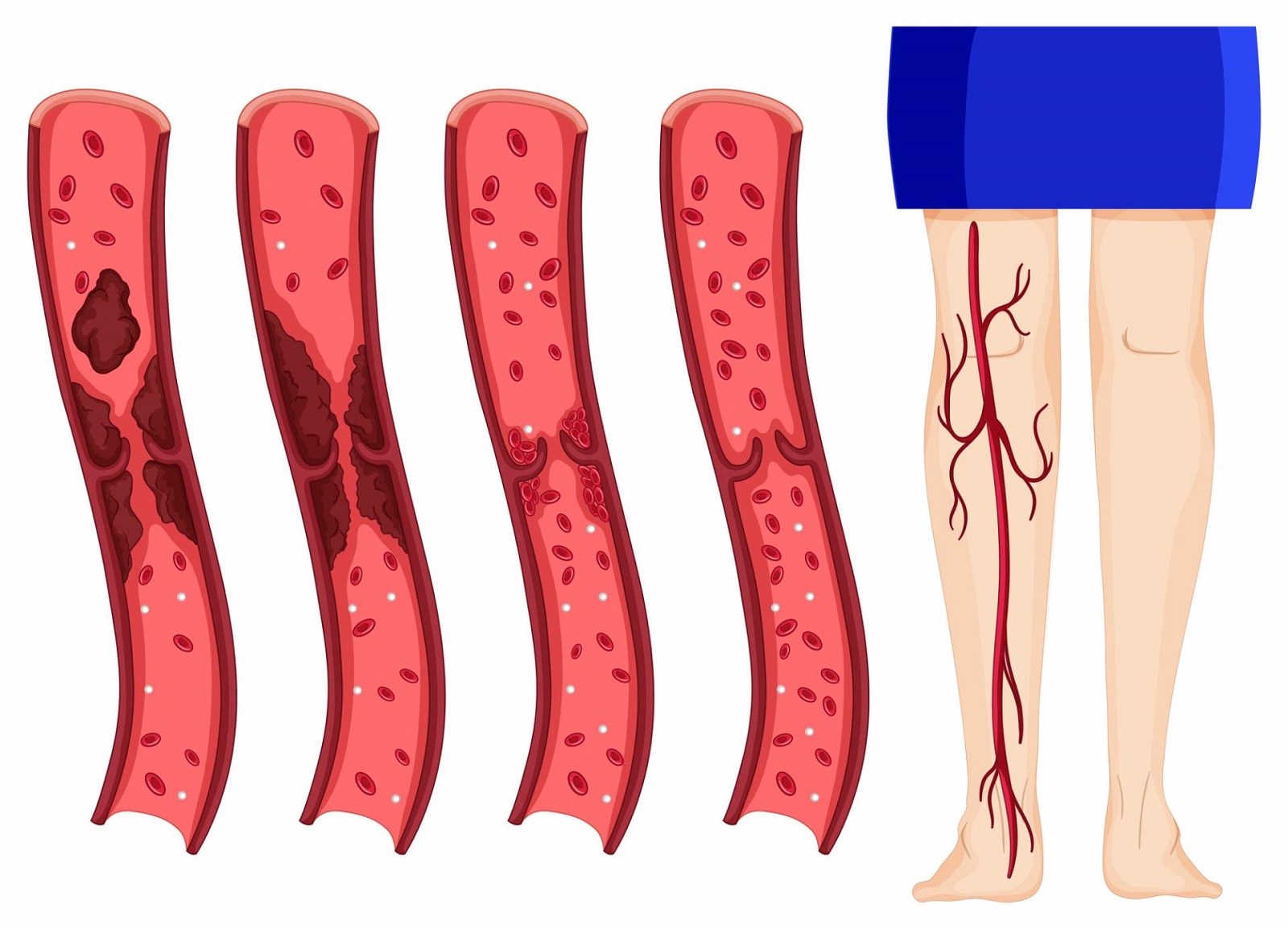 What's the Best Way to Diagnose Blood Clots? - StrideCare