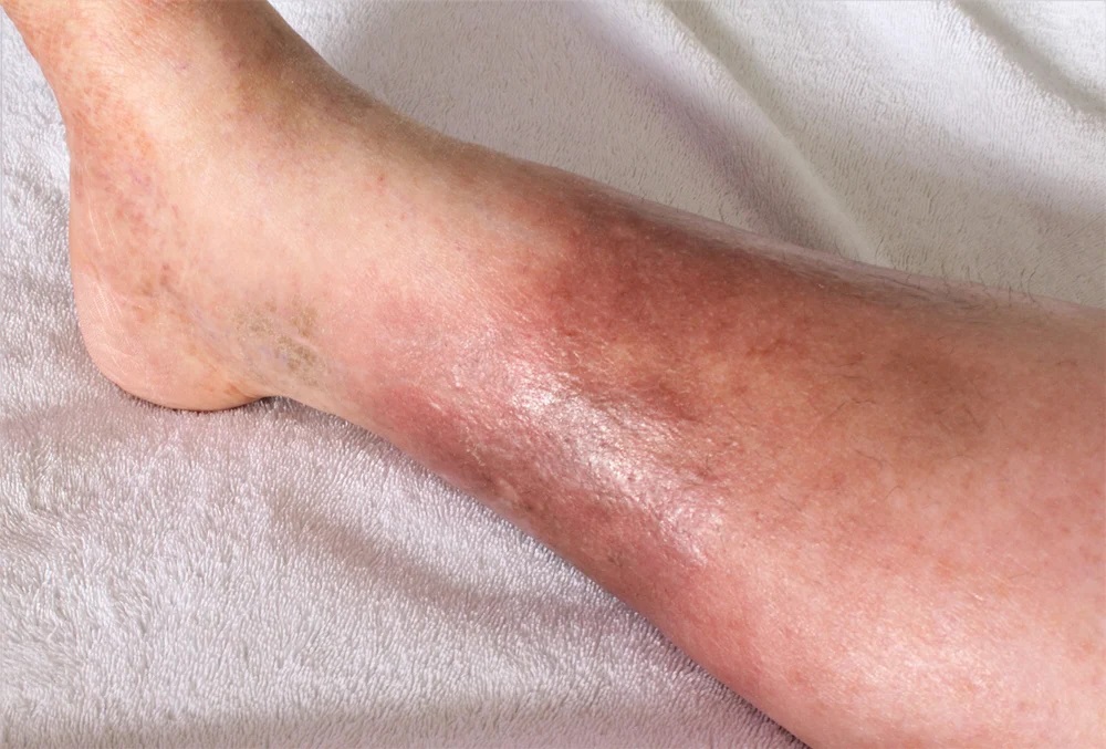 When Leg Skin Discoloration Is Not a Dermatology Issue - StrideCare