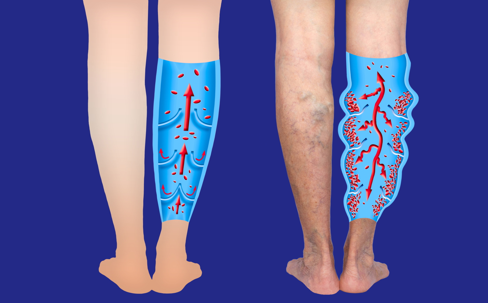Is My Leg Swelling from Lymphedema or Chronic Venous Insufficiency ...