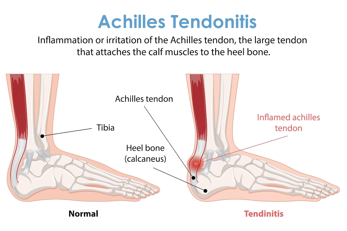 Step Out of Heel Pain: How to Treat and Prevent - StrideCare