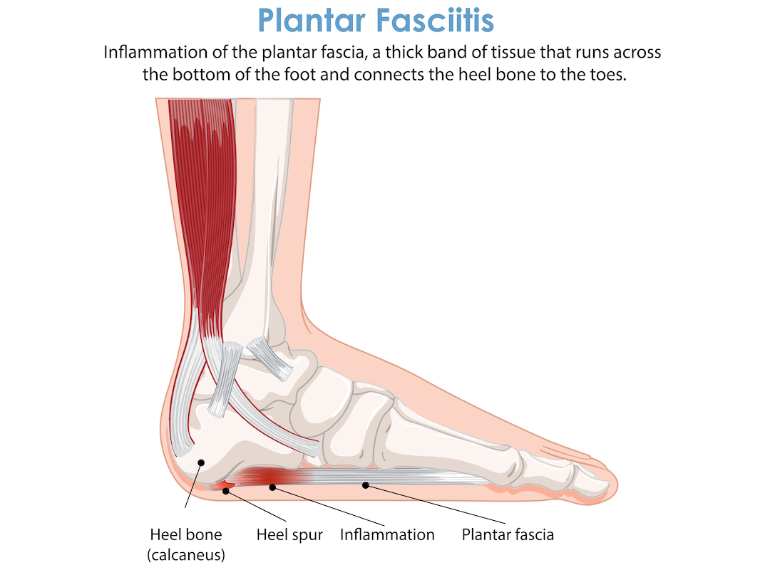 Step Out of Heel Pain: How to Treat and Prevent - StrideCare