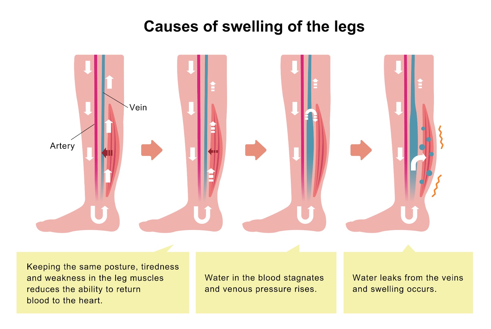 When Is Leg Swelling a Sign of Something Serious? - StrideCare
