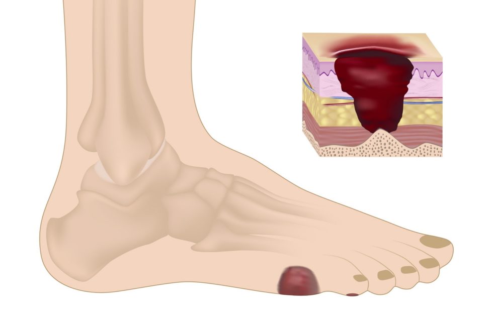 Why Not to Ignore a Leg Ulcer or Sore That Won't Heal - StrideCare