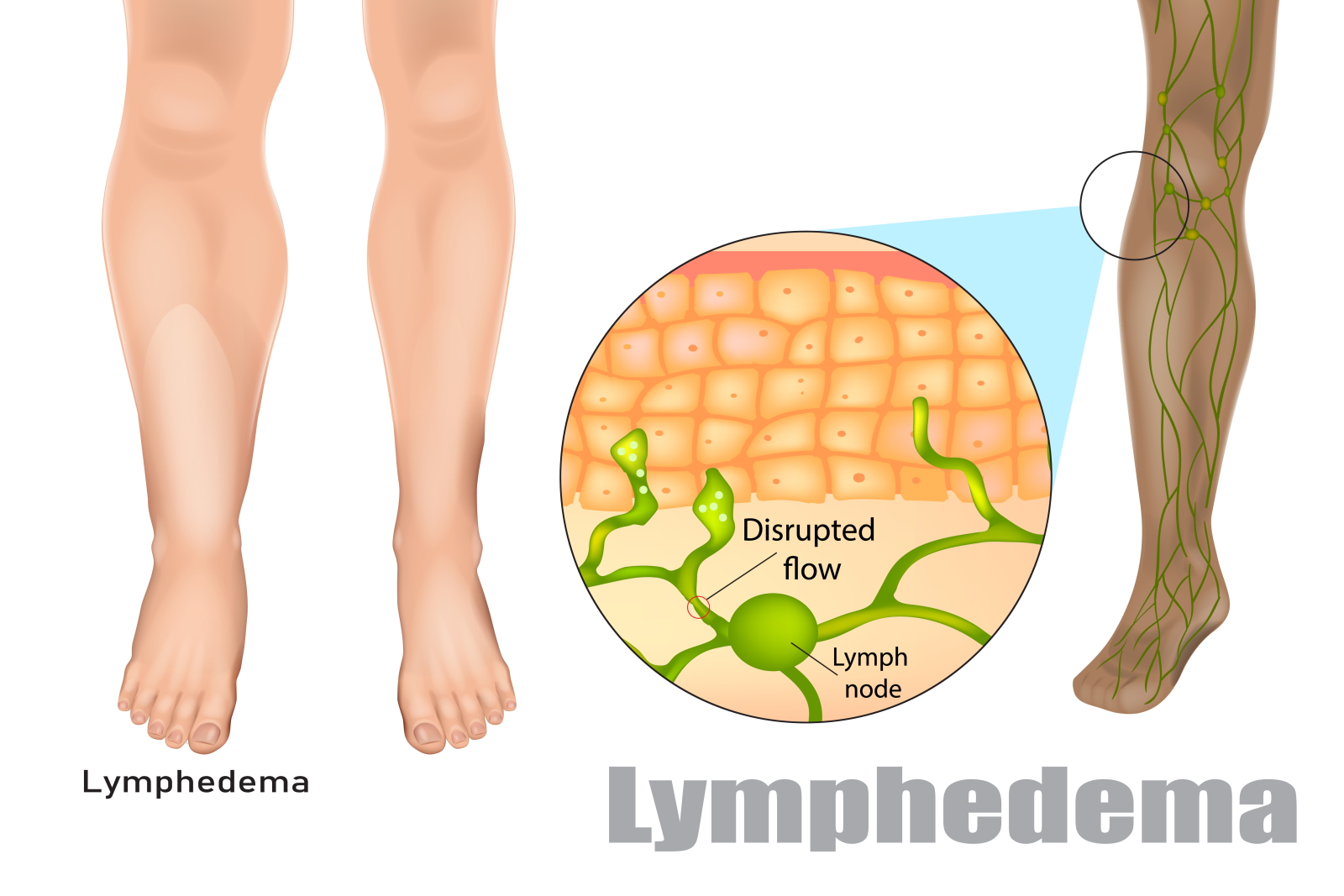 Swollen Lymph Nodes In Legs Metastatic Tumor Definition | Examples And