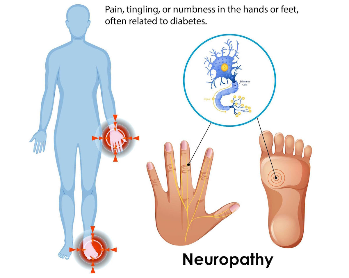 Peripheral Neuropathy: Spinal Cord Stimulation Game-Changer