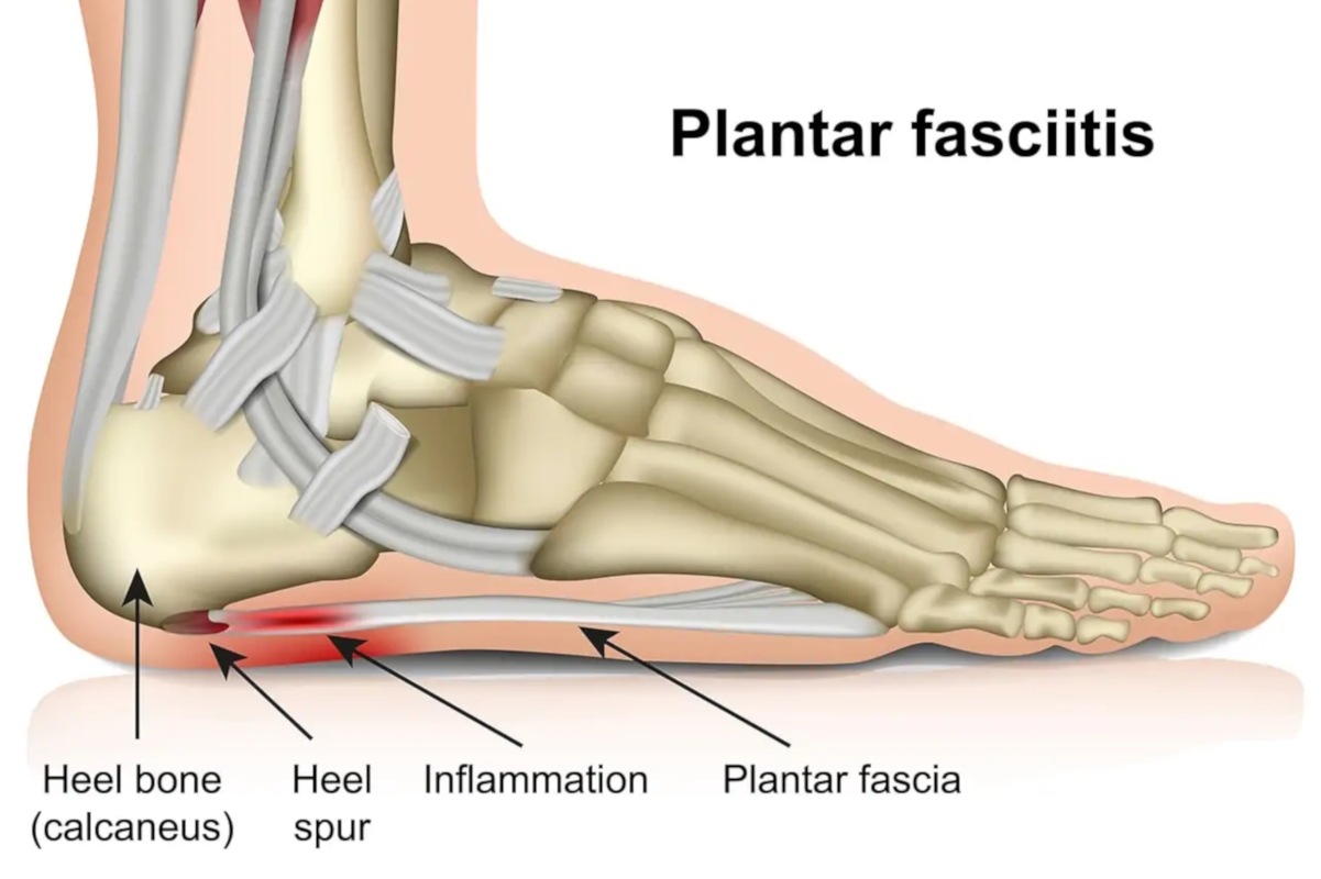 How To Prevent Plantar Fasciitis With Proper Foot Care - StrideCare