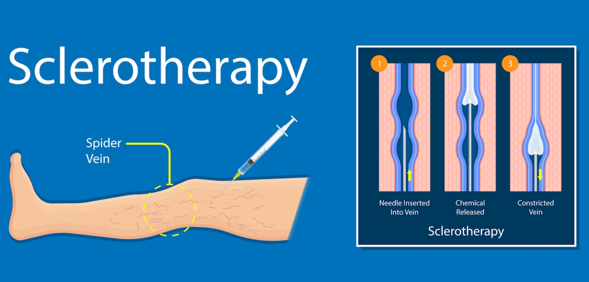 A Guide To Sclerotherapy Vein Treatment Sessions - StrideCare