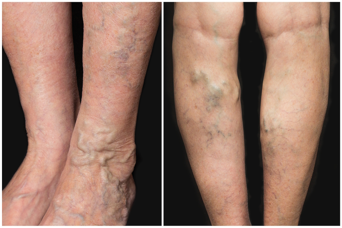 A Guide To Sclerotherapy Vein Treatment Sessions - StrideCare