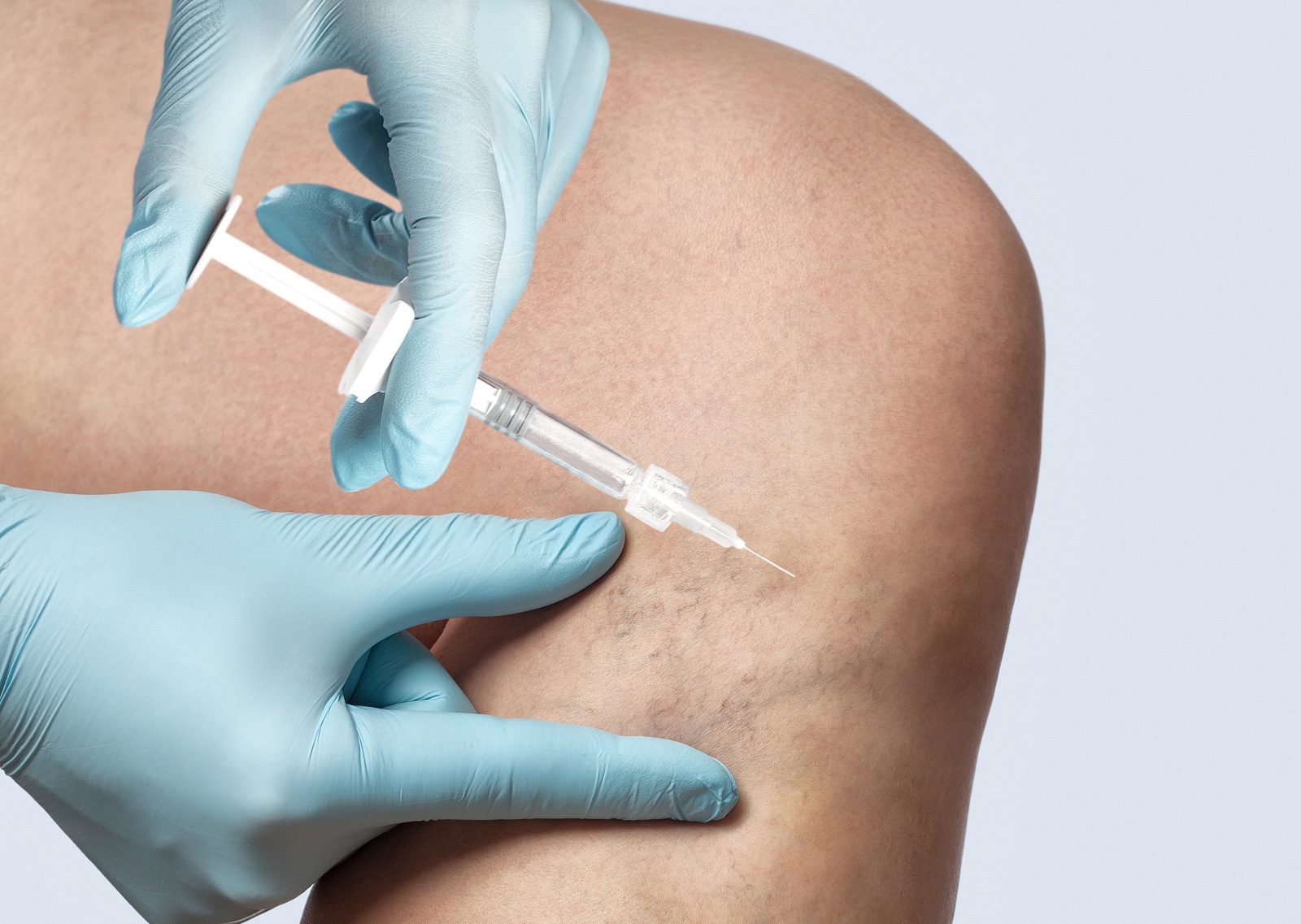 Everything You Need to Know About Sclerotherapy for Spider Vein ...