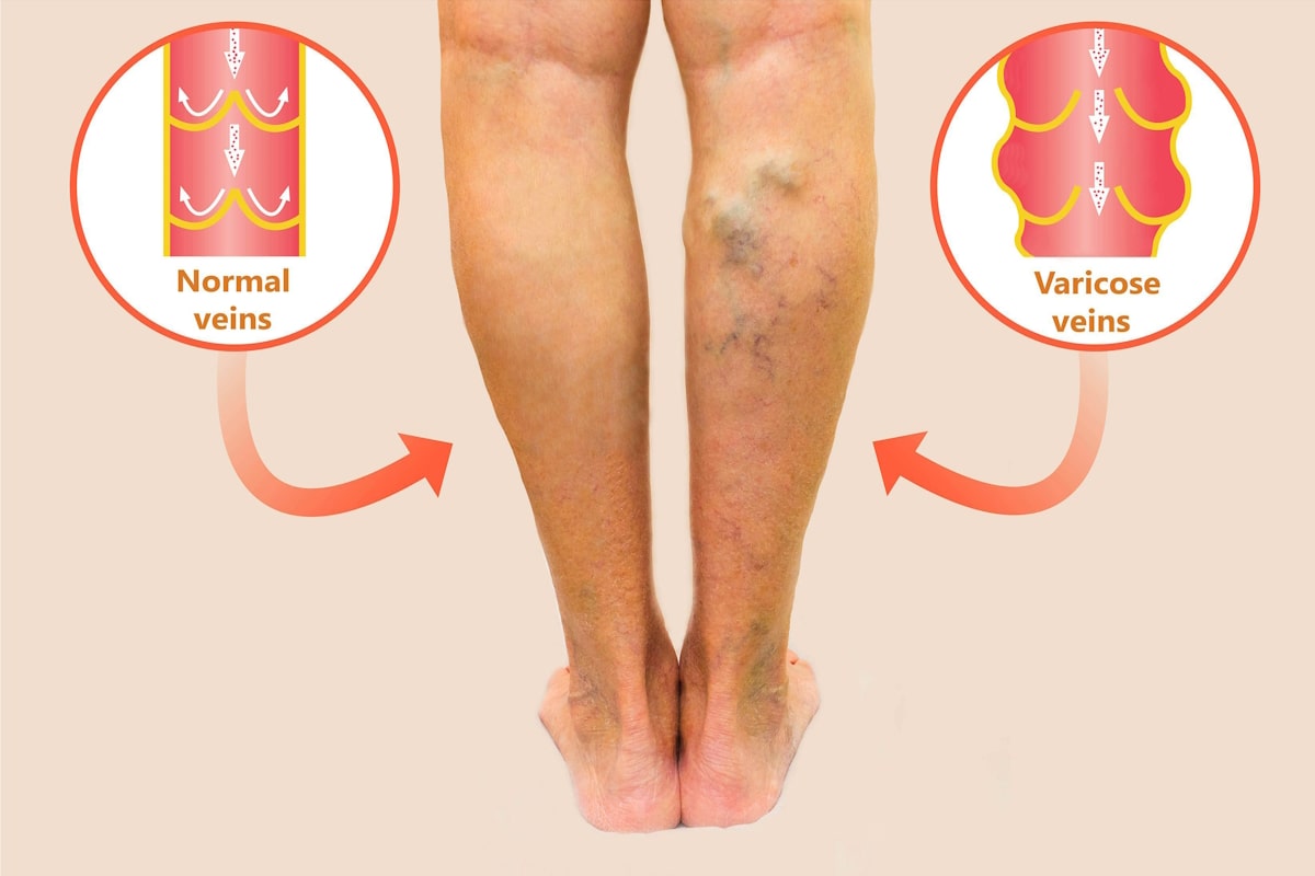 Yes, Spider VVeins Can Occur in Your 20s and 30s - StrideCare