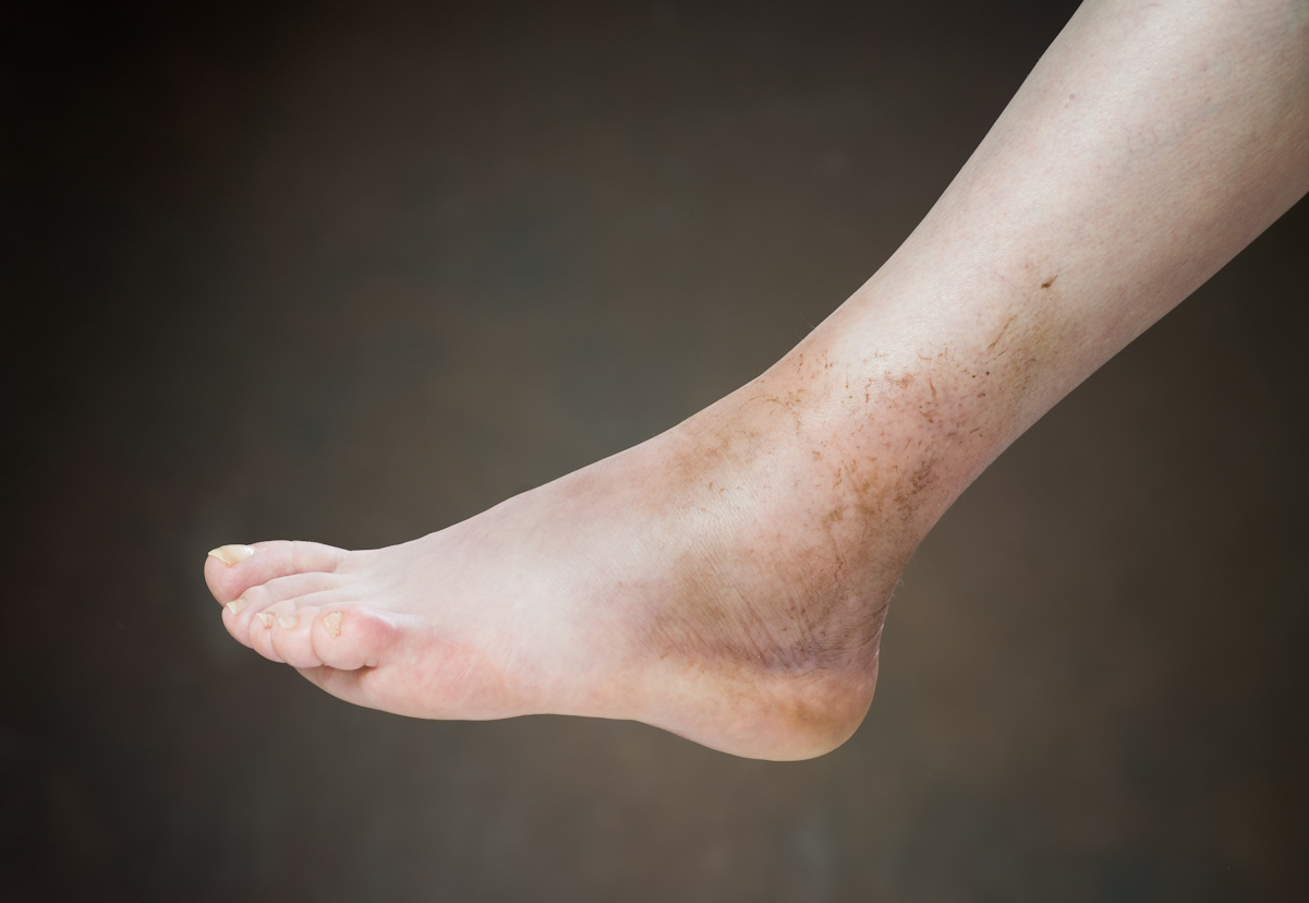 5 Overlooked Symptoms of Vein Disease - StrideCare