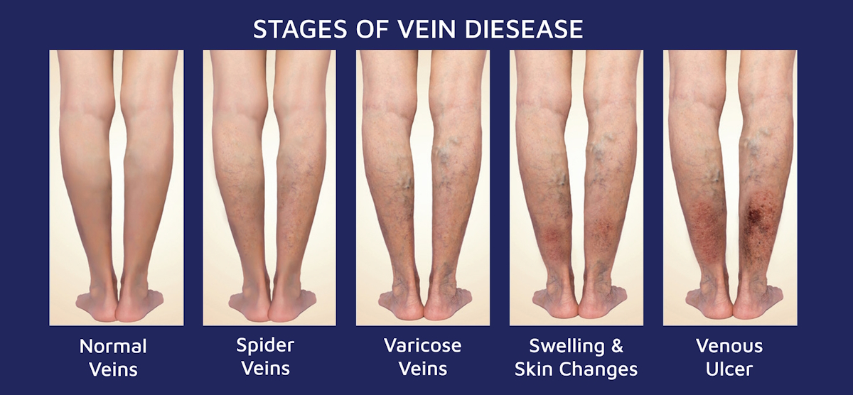 Vein Disease: What Jobs Are Safe For Patients? - StrideCare