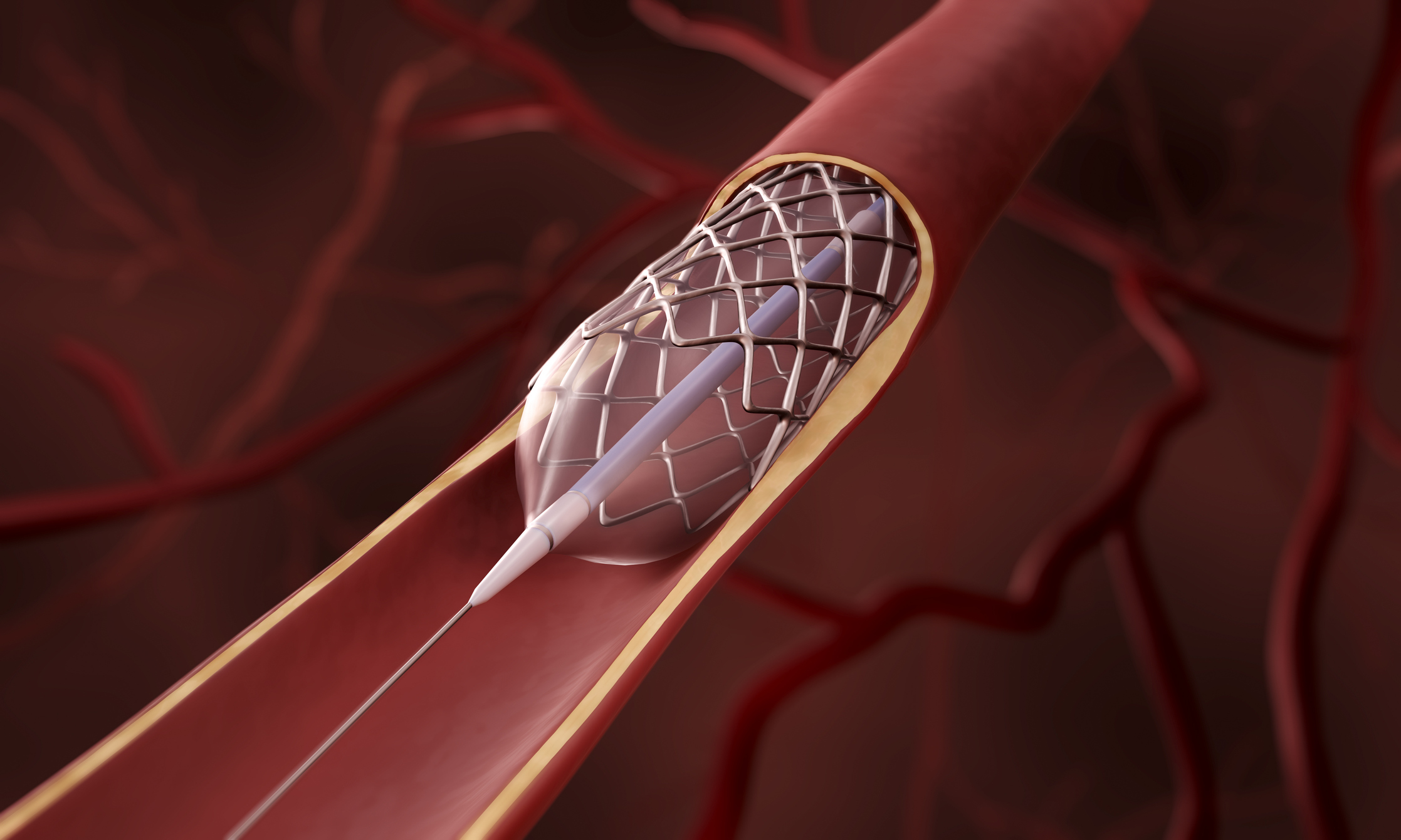 Angioplasty