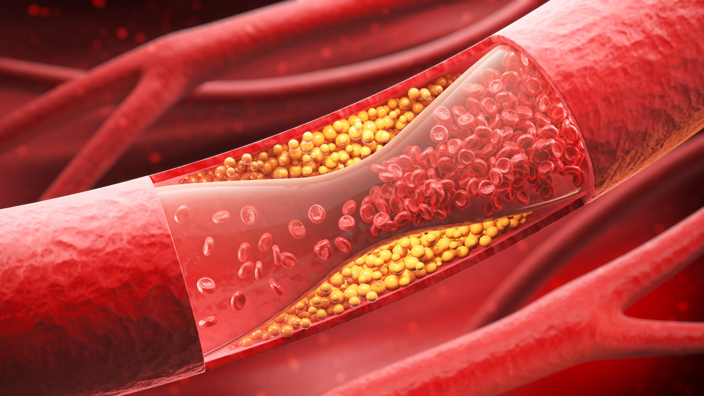 Artery Disease Treatments - StrideCare