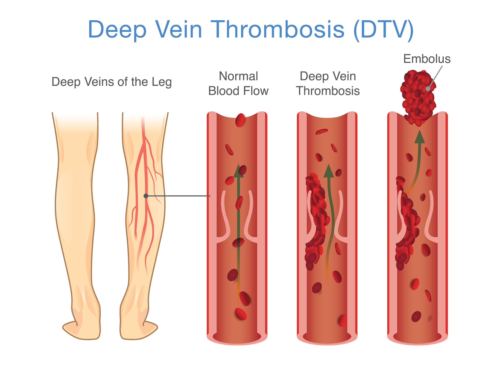 Deep Vein Thrombosis - StrideCare